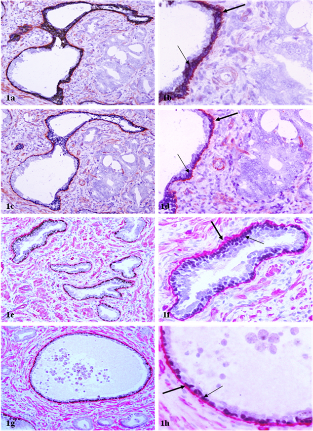 Correlated alterations in prostate basal cell layer and basement membrane