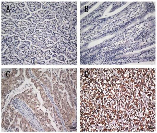 High Level of COP1 Expression is Associated with Poor Prognosis in ...