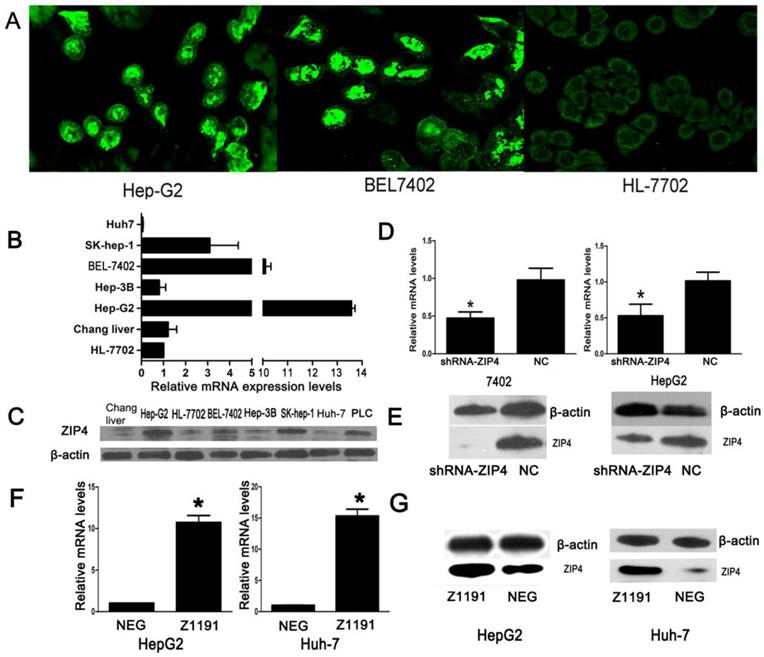 ZIP4, a Novel Determinant of Tumor Invasion in Hepatocellular Carcinoma ...