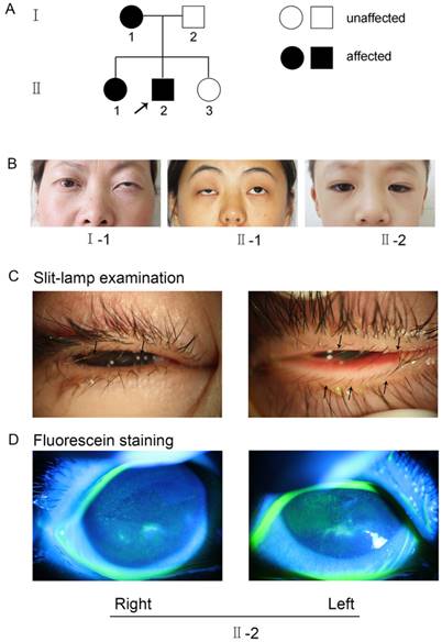 Novel FOXC2 Mutation in Hereditary Distichiasis Impairs DNA-Binding ...