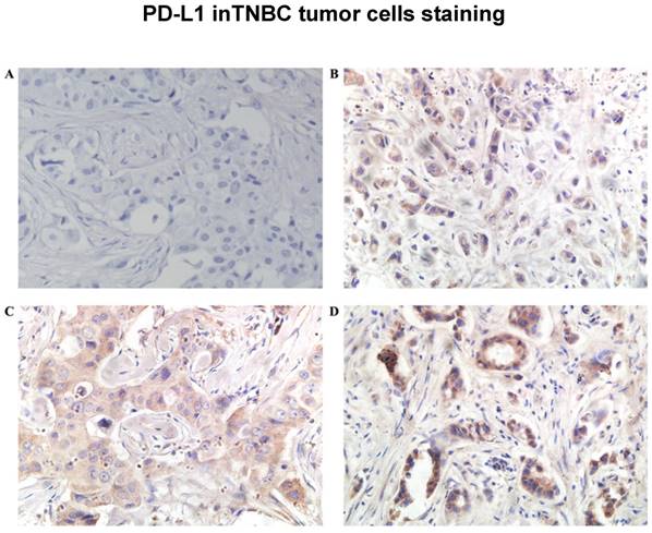 High PD-L1 Expression Is Closely Associated With Tumor-Infiltrating ...
