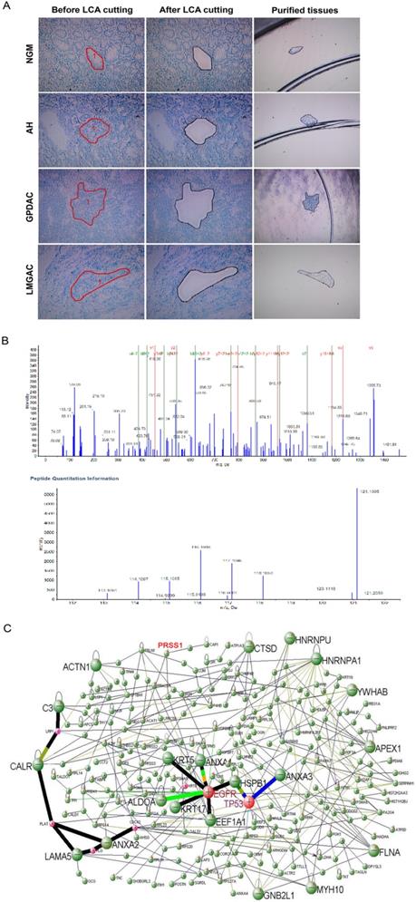 Silencing PRSS1 suppresses the growth and proliferation of gastric ...