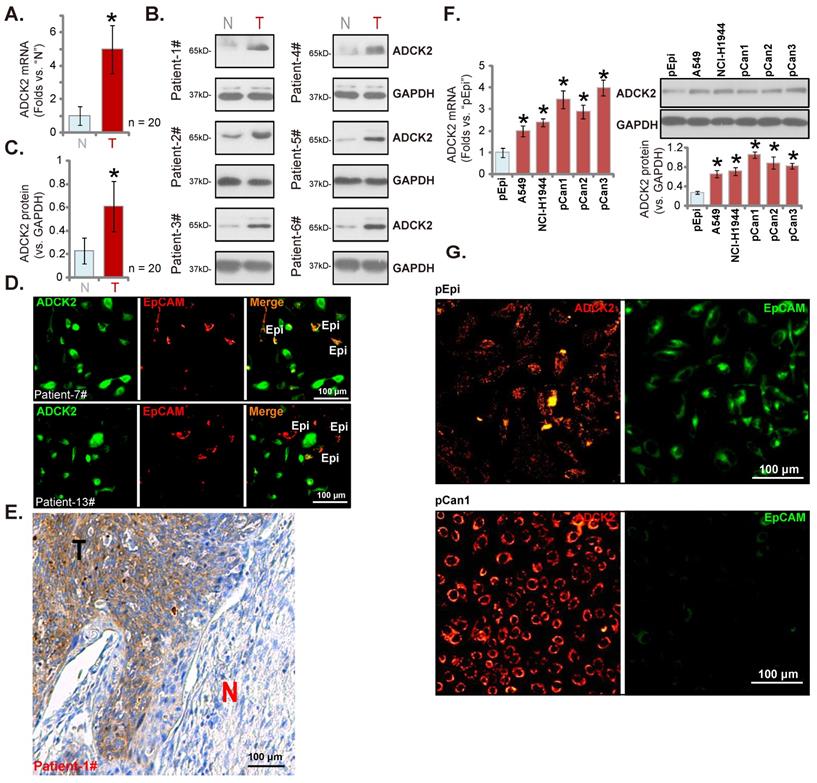 Identification of the mitochondrial protein ADCK2 as a therapeutic oncotarget of NSCLC