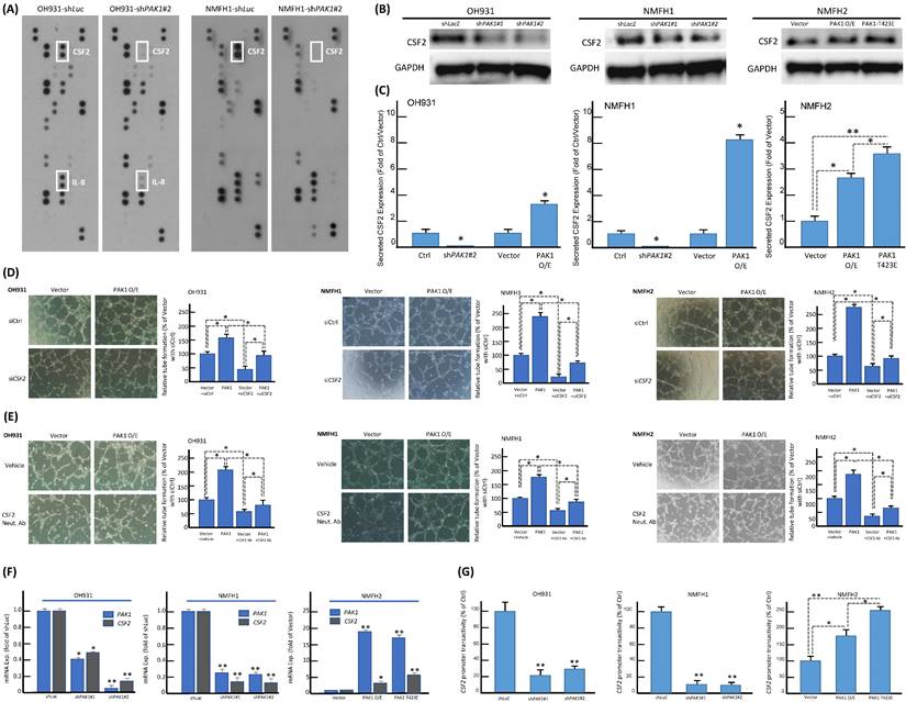 PAK1 overexpression promotes myxofibrosarcoma angiogenesis through ...