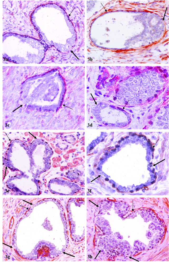 Correlated alterations in prostate basal cell layer and basement membrane