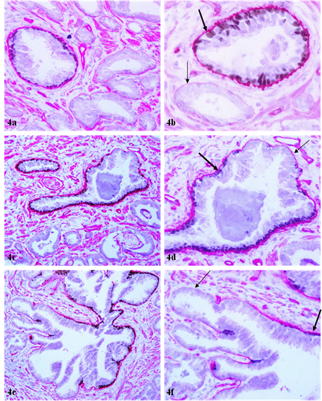 Correlated alterations in prostate basal cell layer and basement membrane