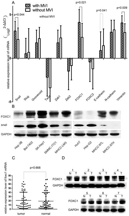 FOXC1 Contributes To Microvascular Invasion In Primary Hepatocellular ...