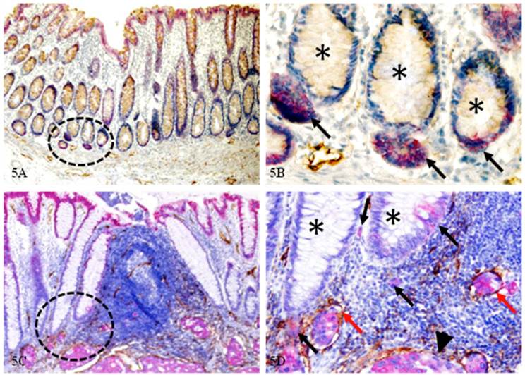 Cell Budding from Normal Appearing Epithelia: A Predictor of Colorectal ...