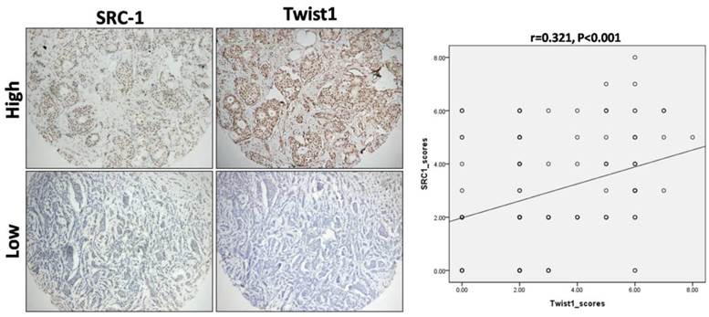SRC-1 and Twist1 Expression Positively Correlates with a Poor Prognosis ...