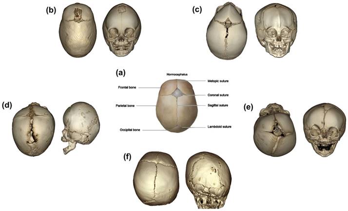 Signaling Mechanisms Underlying Genetic Pathophysiology of Craniosynostosis