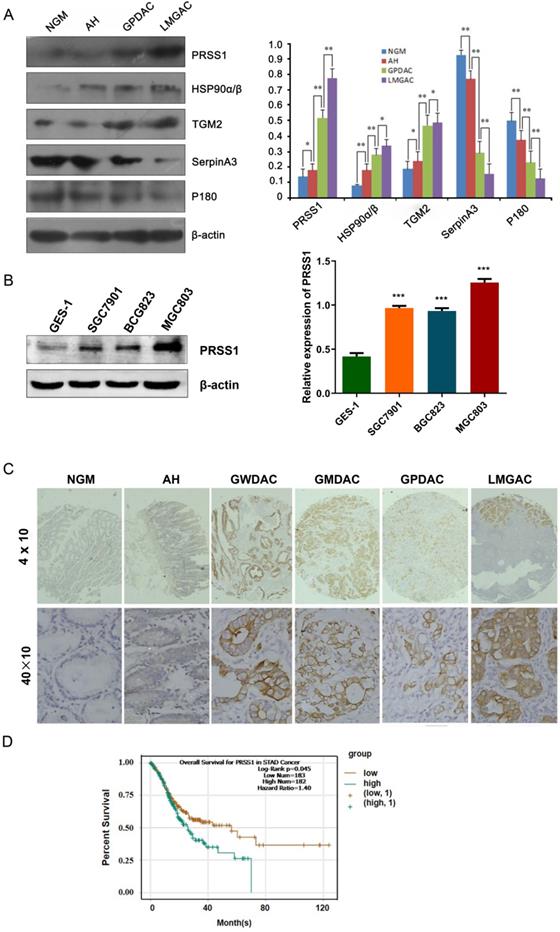 Silencing PRSS1 suppresses the growth and proliferation of gastric ...