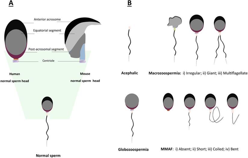 Towards Post-Meiotic Sperm Production: Genetic Insight into Human ...