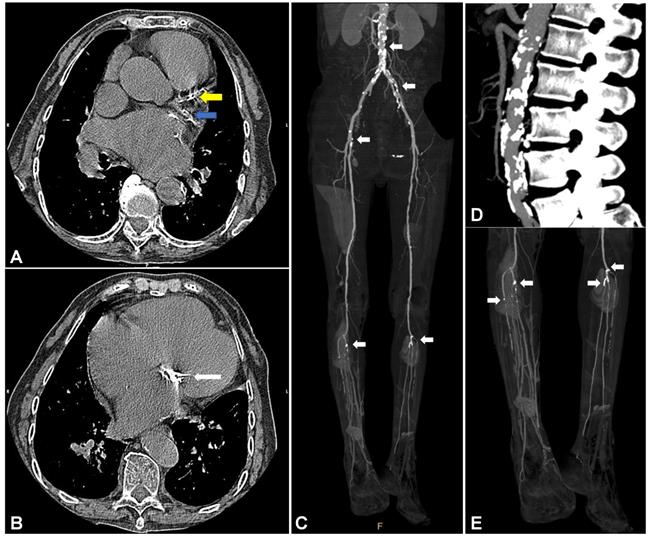 IL-1β in atherosclerotic vascular calcification: From bench to bedside