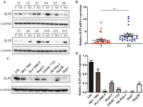 SLPI suppresses hepatocellular carcinoma progression via endoplasmic ...