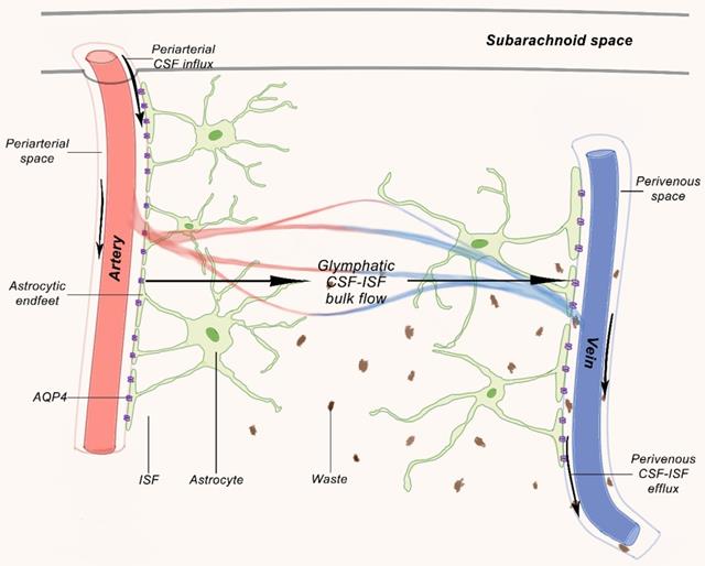 Cerebral microinfarct is emergency consequence of Alzheimer's disease ...