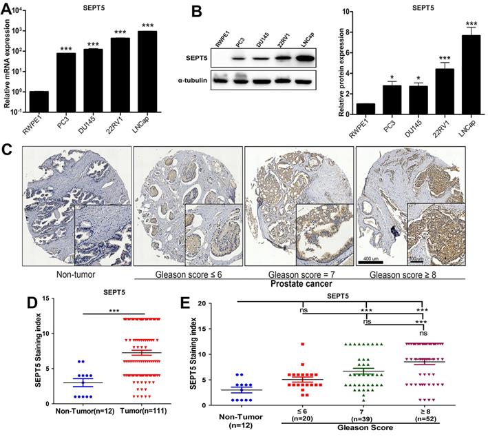Downregulation of SEPTIN5 inhibits prostate cancer progression by ...