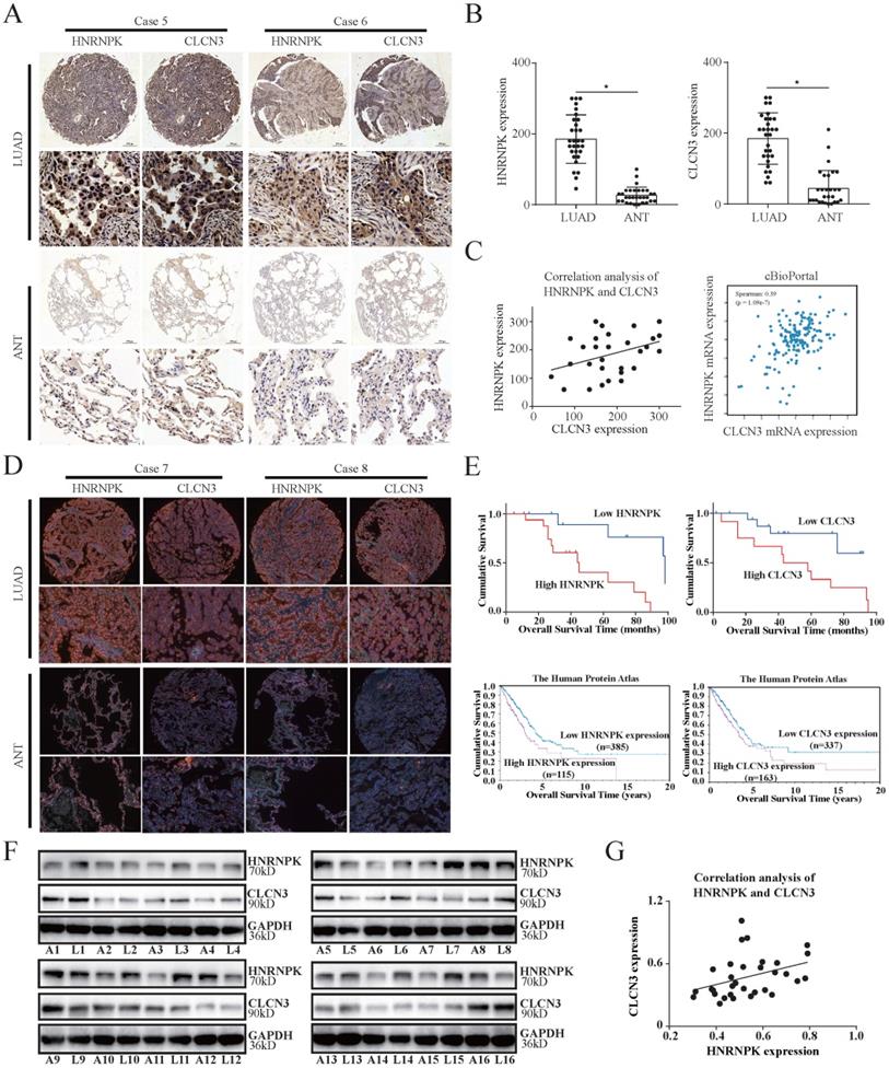 HNRNPK/CLCN3 axis facilitates the progression of LUAD through CAF-tumor ...