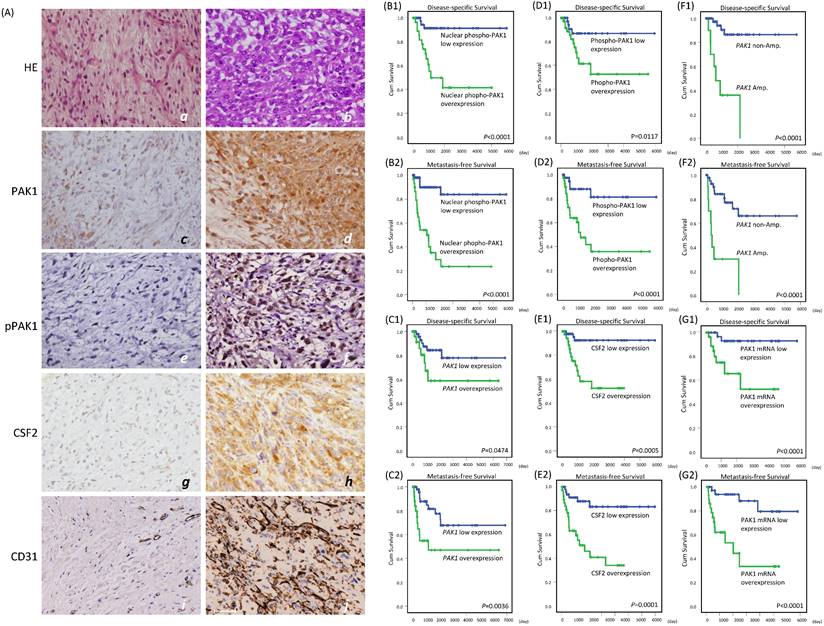 PAK1 overexpression promotes myxofibrosarcoma angiogenesis through ...
